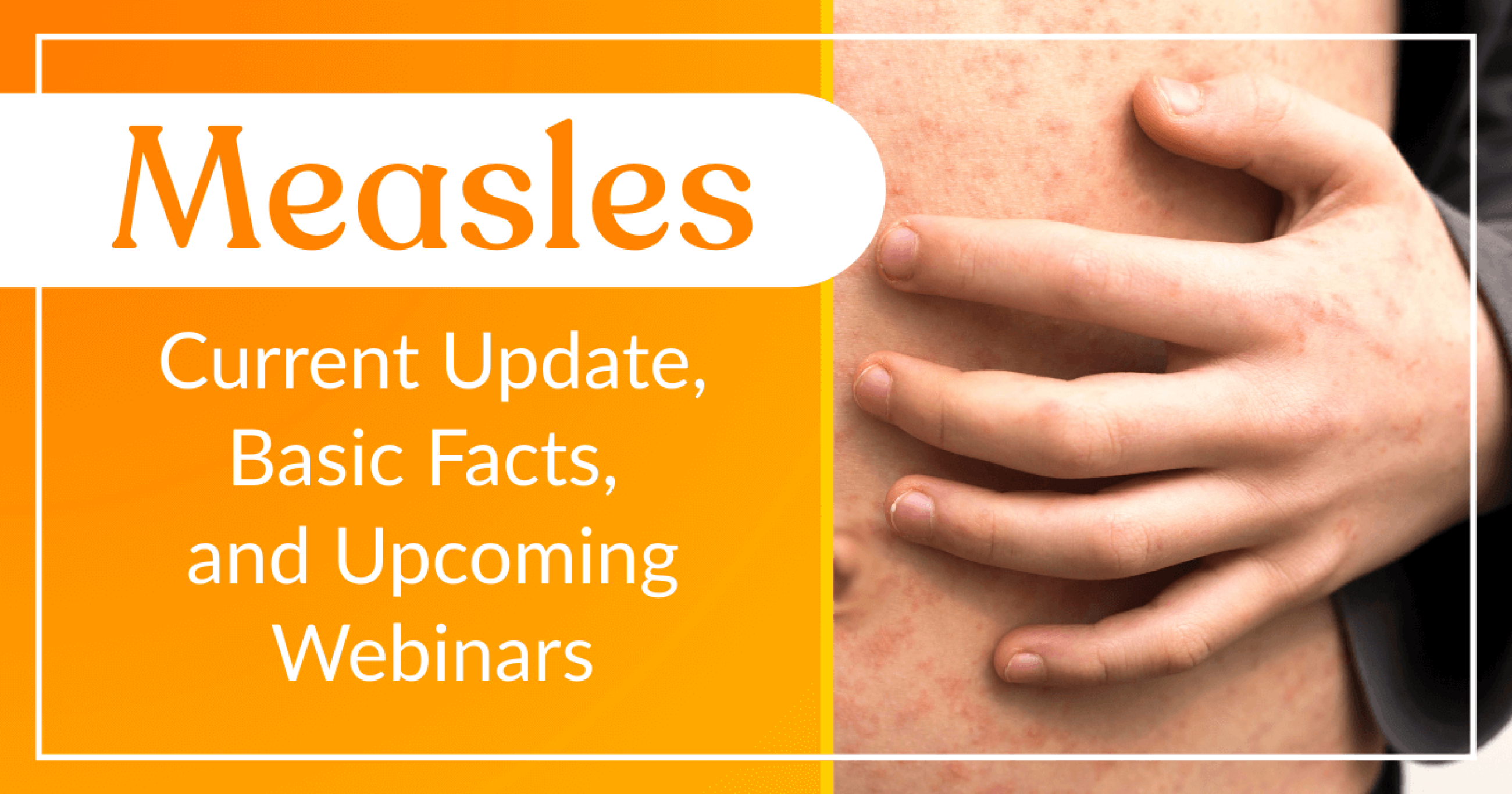 Measles: Current Update, Basic Facts, and Upcoming Webinars | Migrant Clinicians Network